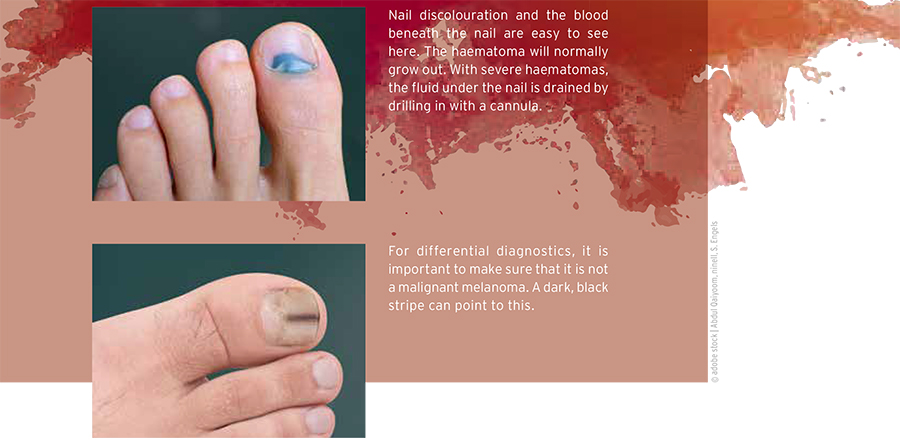 Under the Nail - Gehwol Footcare